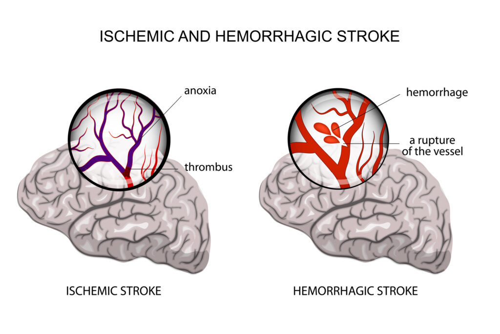 Can Brain Surgery Treat a Stroke?