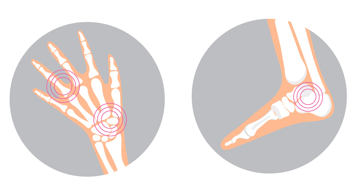 Details Surrounding Juvenile Idiopathic Arthritis (JIA)