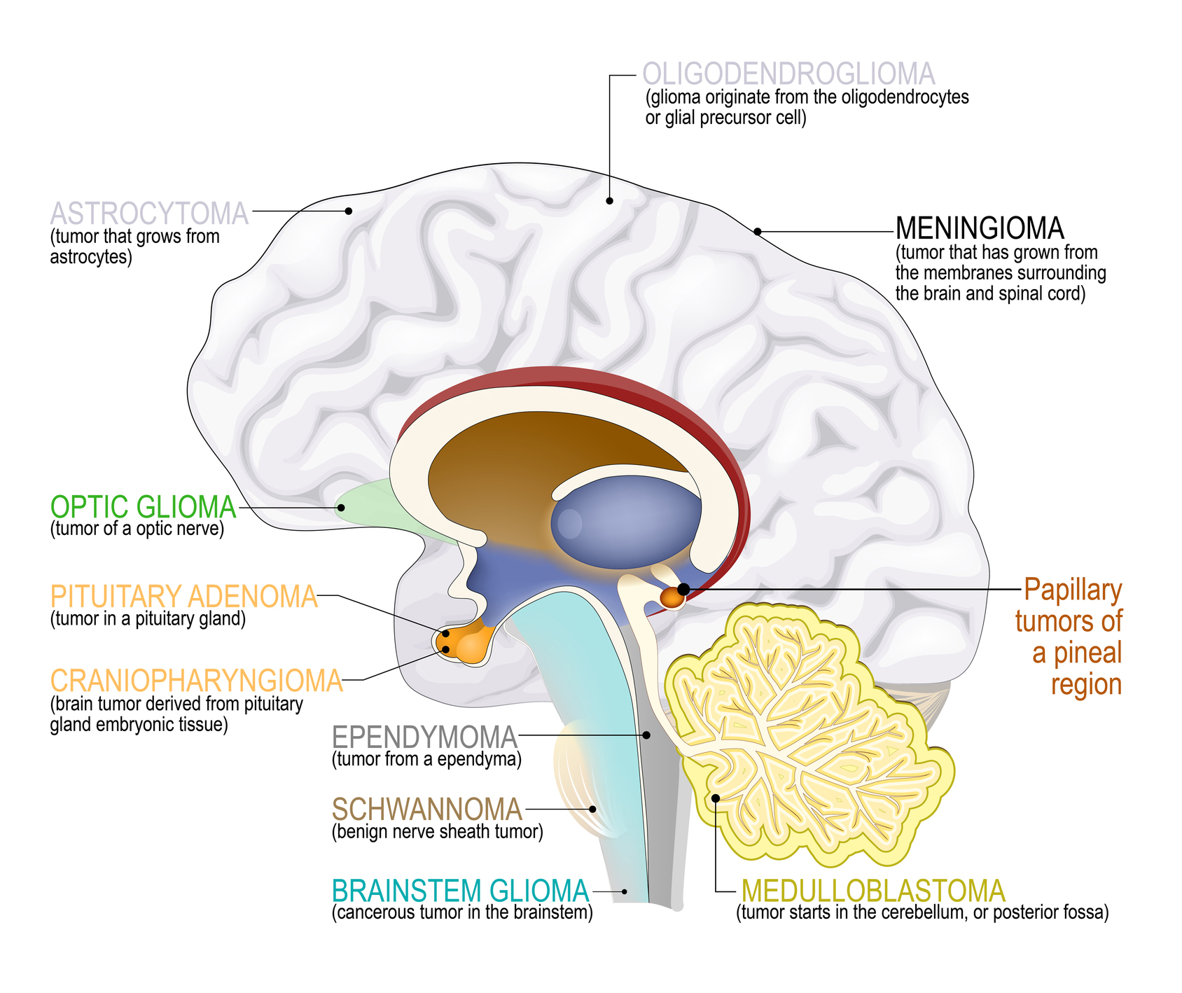 Pediatric Brain Tumor: A Comprehensive Overview