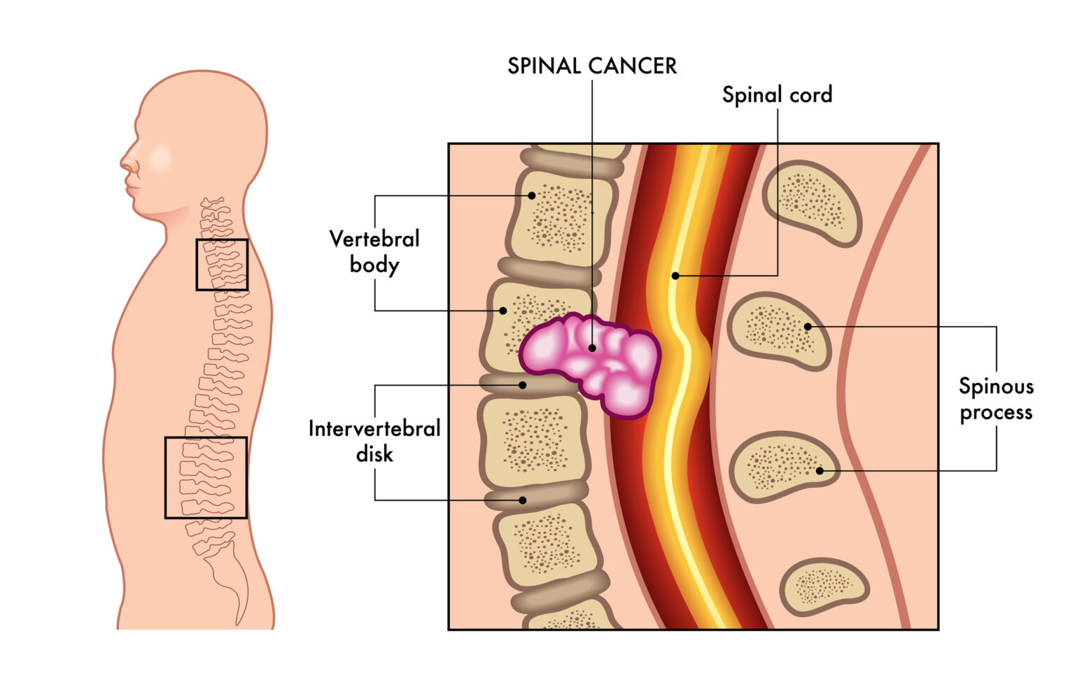 What are metastatic spinal tumors?